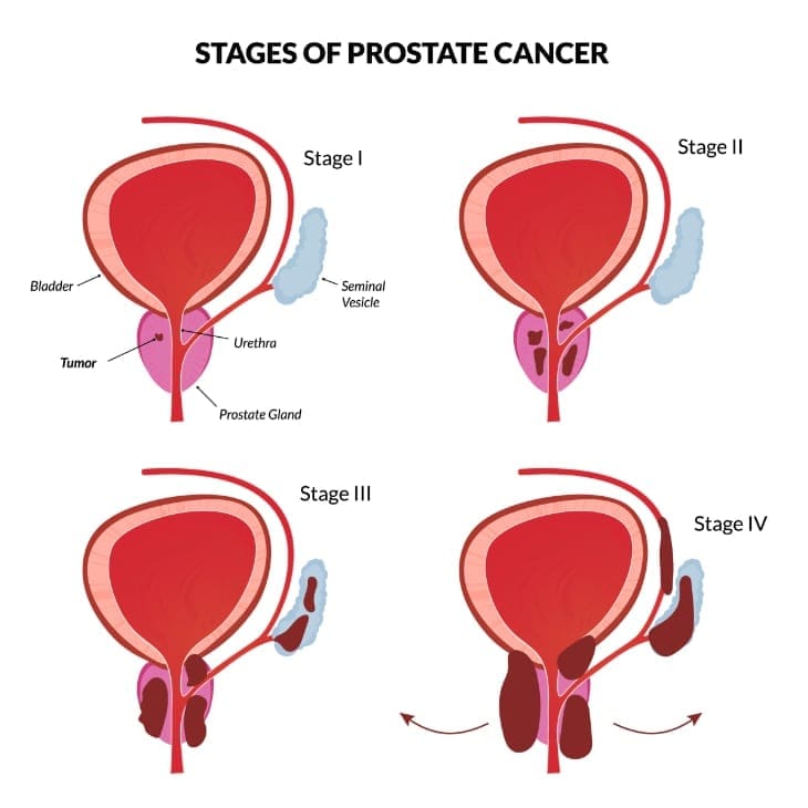 Top Prostate Cancer Doctors & Specialists In Texas