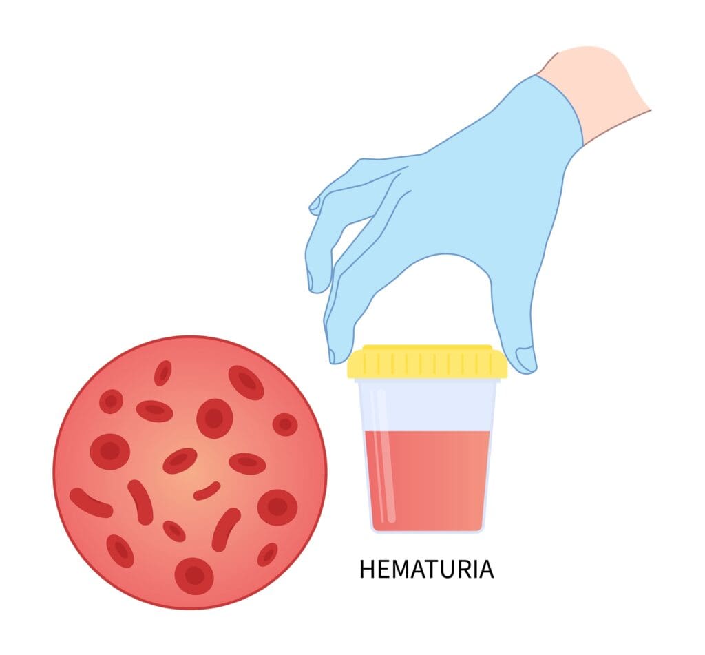 Best Hematuria Doctors At Hematuria Clinic In North Texas