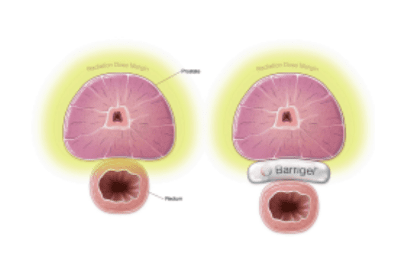 Enhancing Prostate Cancer Care With Barrigel And SpaceOAR