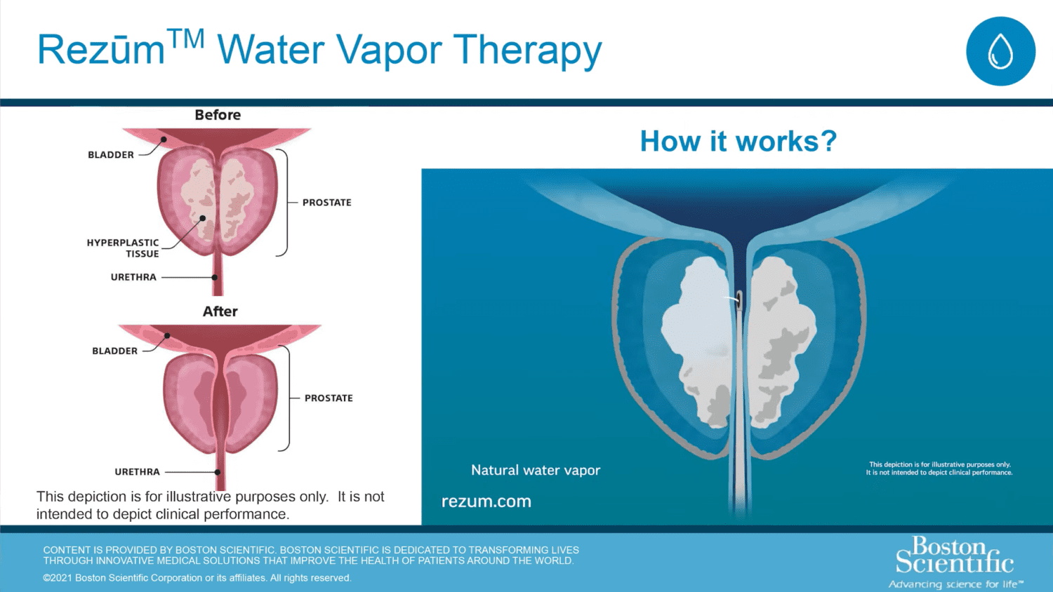 Rezum™ Water Vapor Therapy For BPH | Dallas-Fort Worth | UPNT