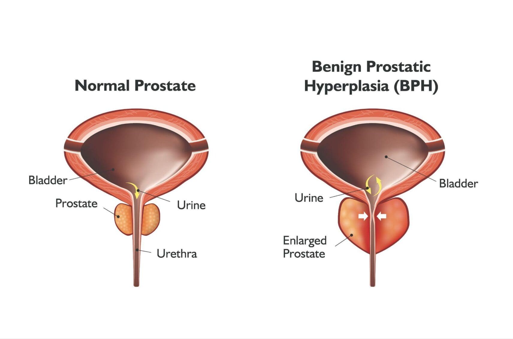 UroLift® System For BPH Treatment In Dallas-Fort Worth | UPNT