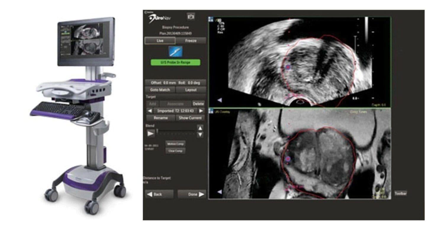MRI Fusion Prostate Biopsy For Accurate Diagnosis | UPNT North Texas