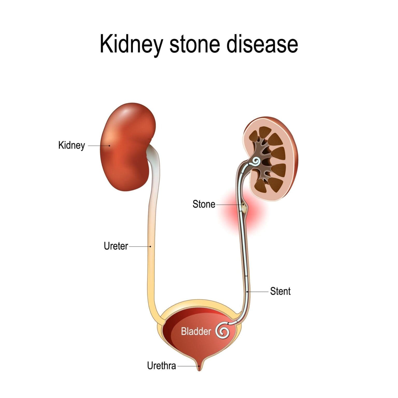 ESWL Shock Wave Lithotripsy For Kidney Stones | North Texas | UPNT