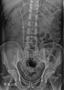 PCNL Surgery For Large Kidney Stones | Dallas-Fort Worth | UPNT