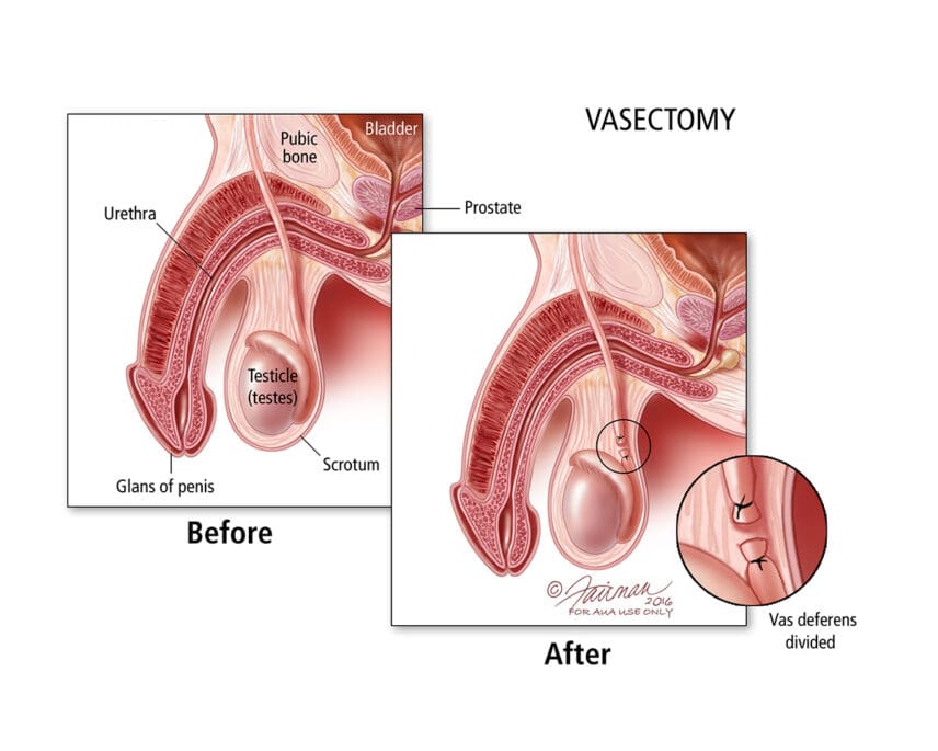 No-Scalpel Vasectomy In DFW | Permanent Birth Control | UPNT