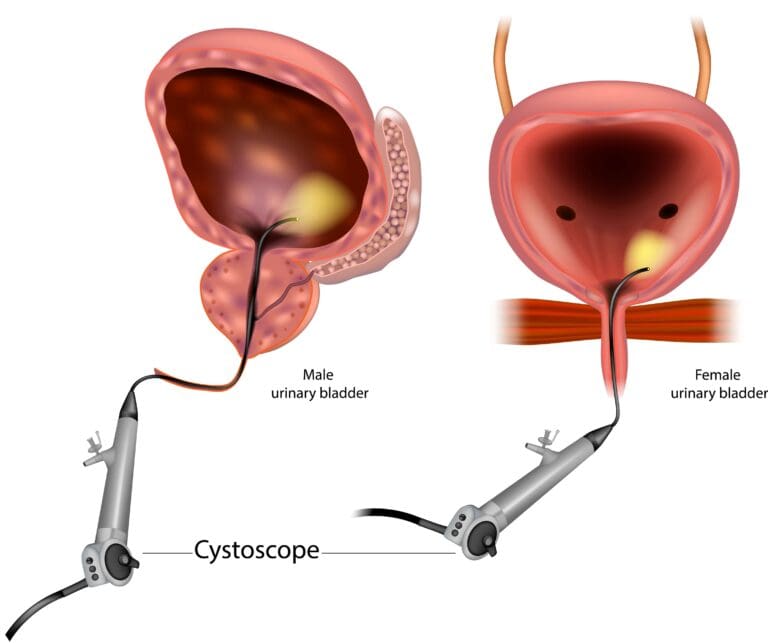 Cystoscopy Procedure For Bladder & Urethra Diagnosis | DFW | UPNT
