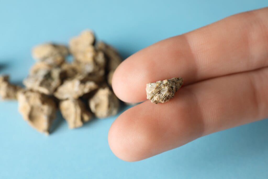 CULLS Laser Lithotripsy For Kidney Stones | North Texas | UPNT