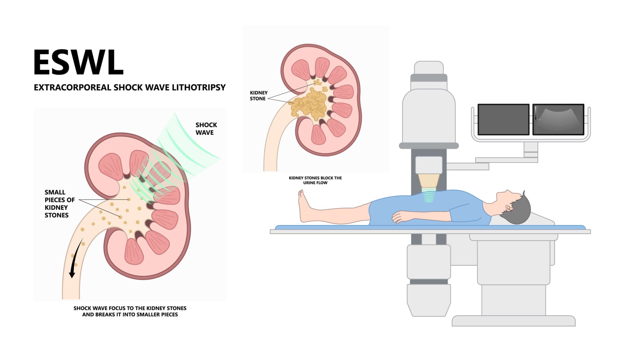 ESWL Shock Wave Lithotripsy For Kidney Stones | North Texas | UPNT