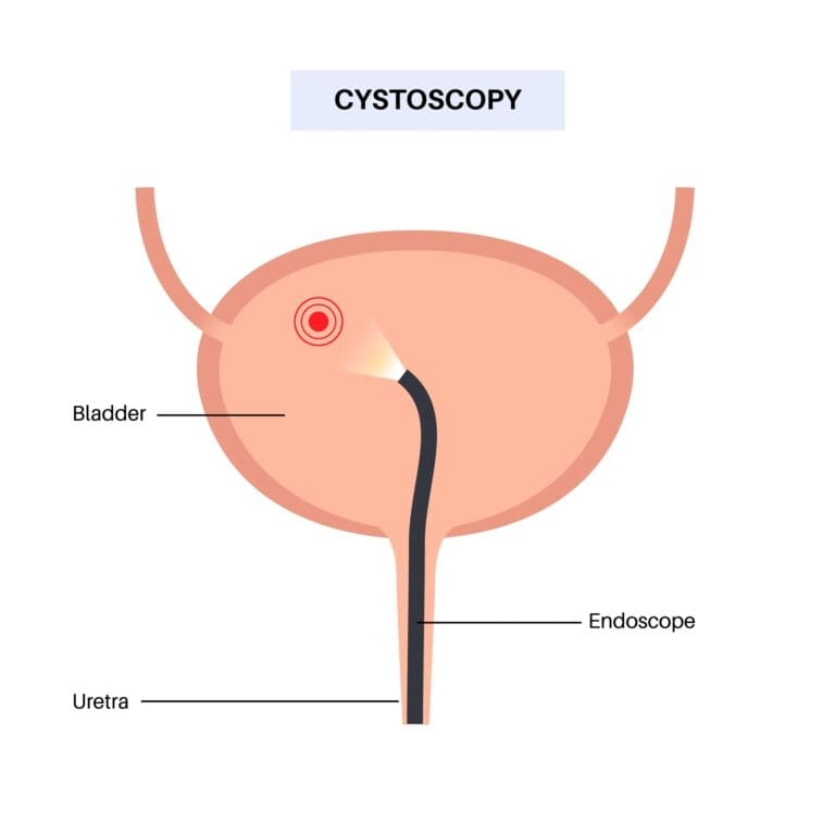 Cystoscopy Procedure For Bladder & Urethra Diagnosis | DFW | UPNT