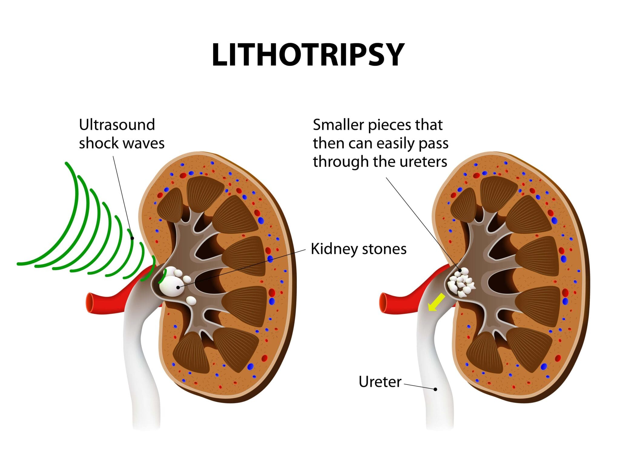 ESWL Shock Wave Lithotripsy For Kidney Stones | North Texas | UPNT