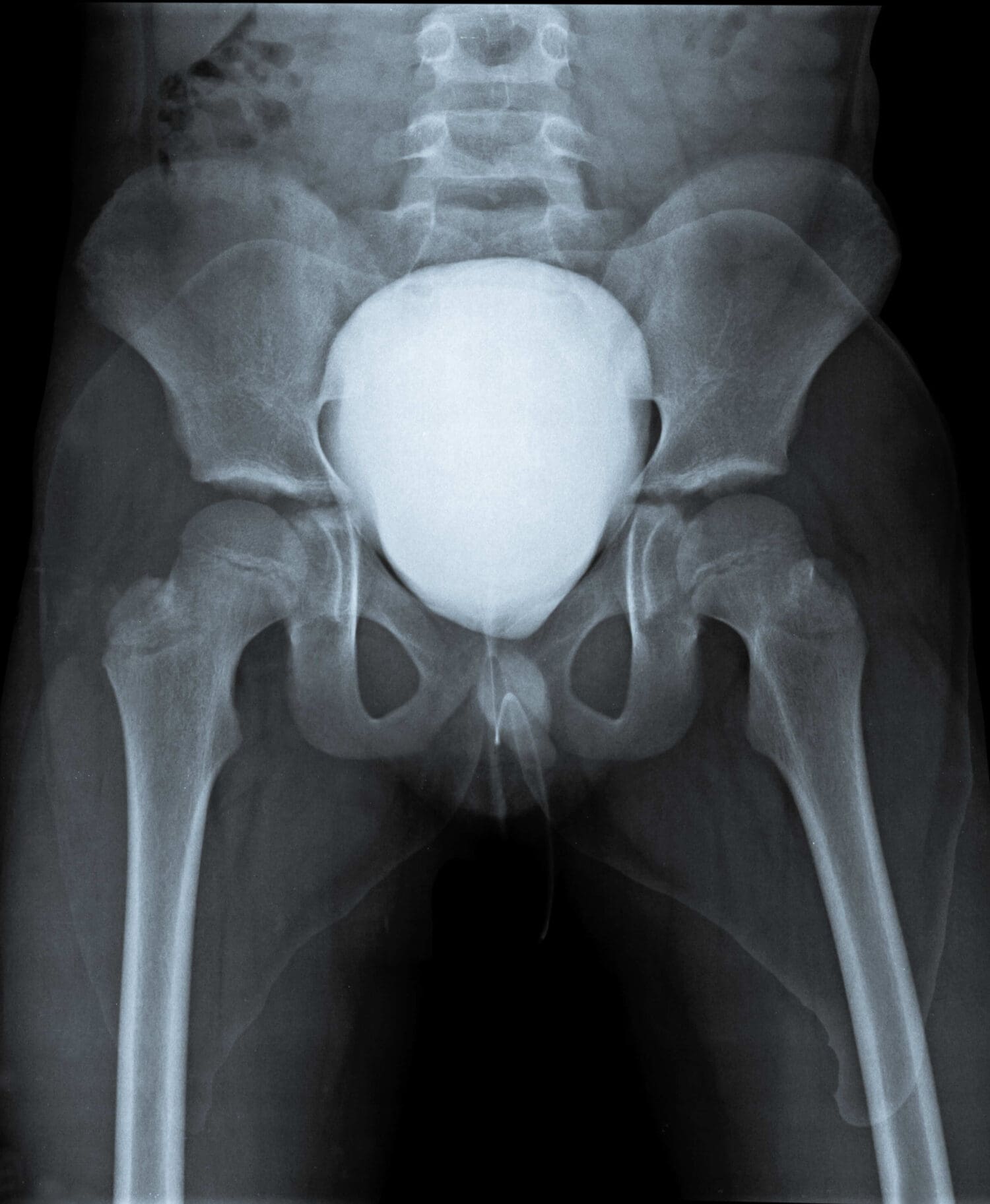 Urodynamics Testing For Bladder Function | North Texas | UPNT