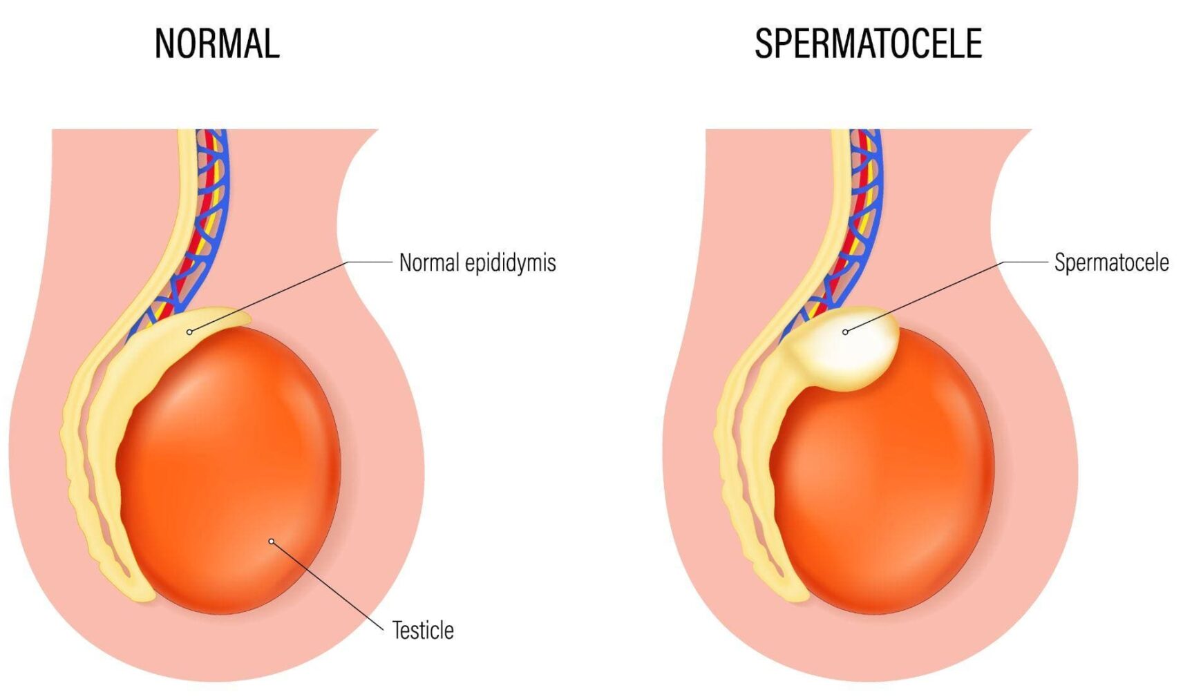 Spermatocele (Epididymal Cyst) Diagnosis & Treatment | DFW | UPNT