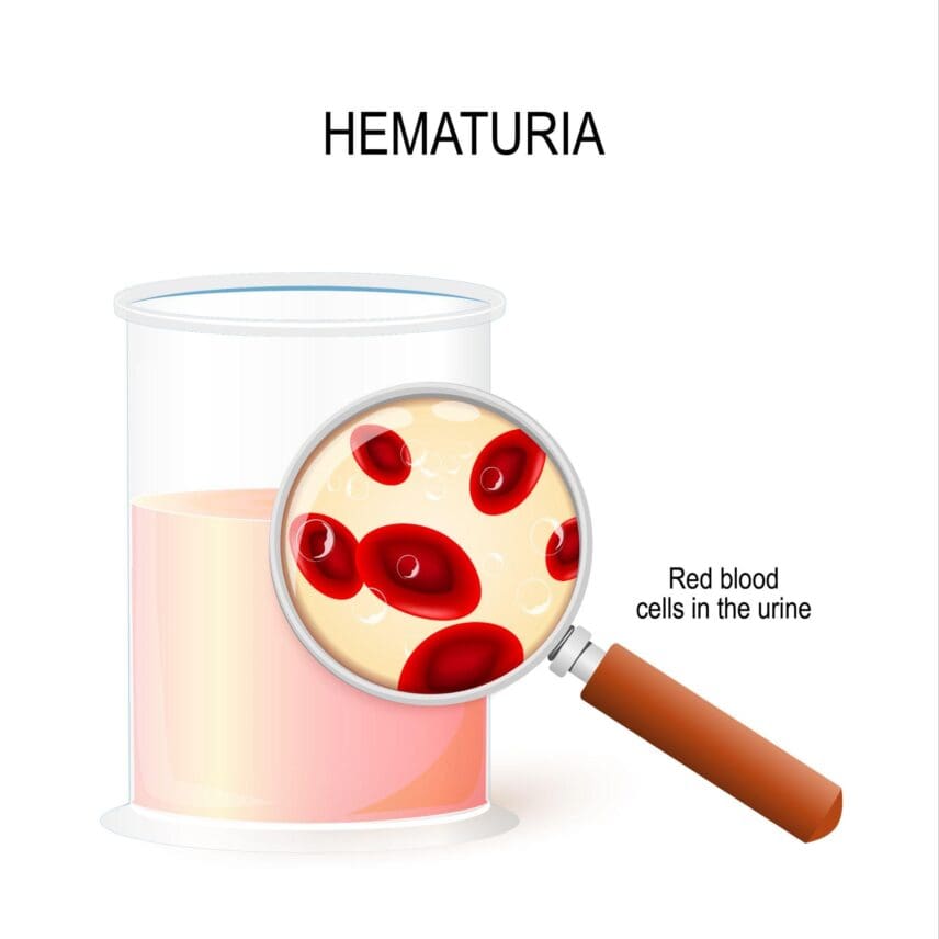Hematuria (Blood In Urine) Diagnosis In Dallas-Fort Worth | UPNT