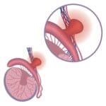 Spermatocele (Epididymal Cyst) Diagnosis & Treatment | DFW | UPNT