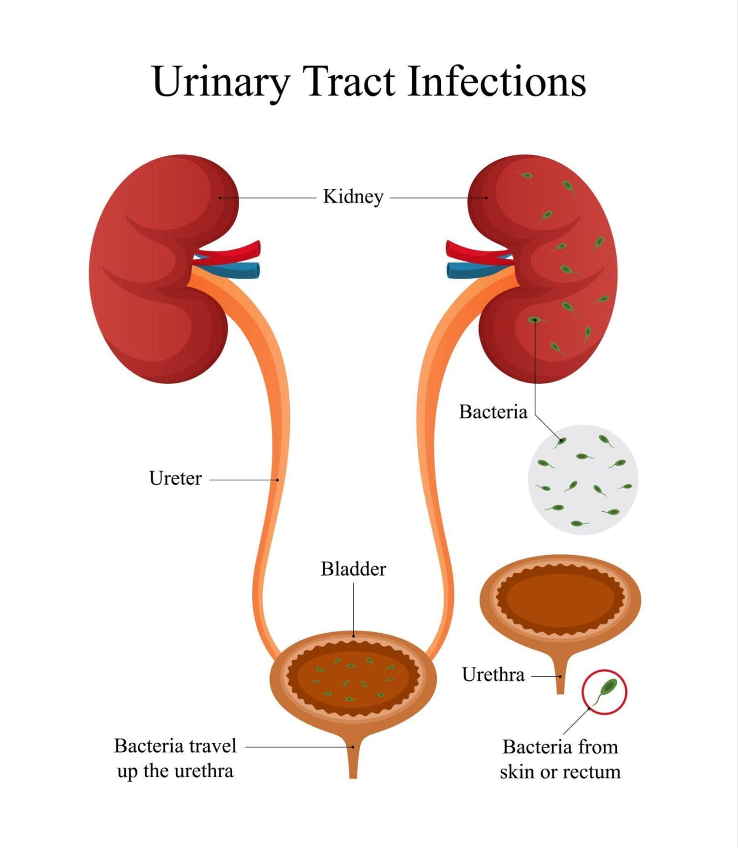 UTI Treatment For Women | Expert Female Care At UPNT