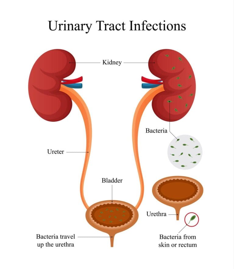 UTI Treatment For Women | Expert Female Care At UPNT