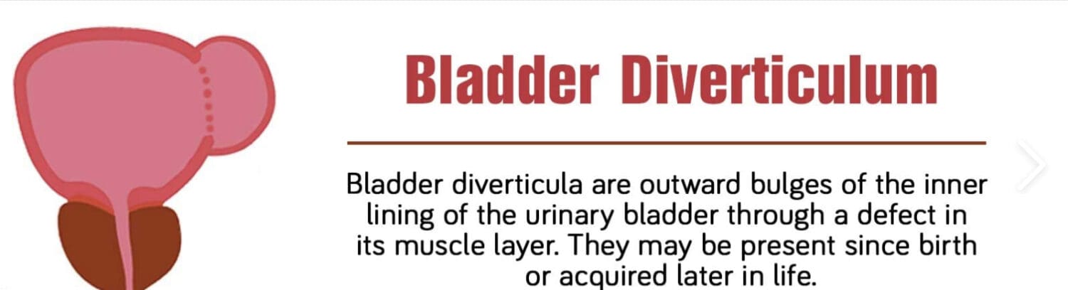 Bladder Diverticulum Diagnosis & Treatment | DFW | UPNT