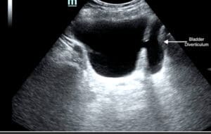 Bladder Diverticulum Diagnosis & Treatment | DFW | UPNT