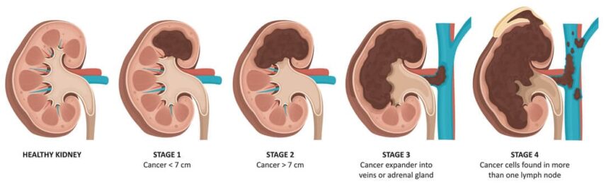 Kidney Cancer & Renal Mass Treatment | Robotic Surgery UPNT