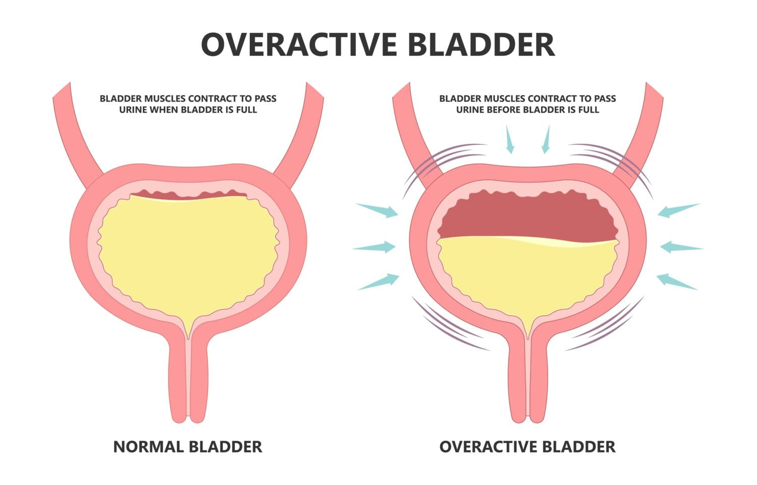 Women's OAB & Urge Incontinence Treatment | Dallas | UPNT